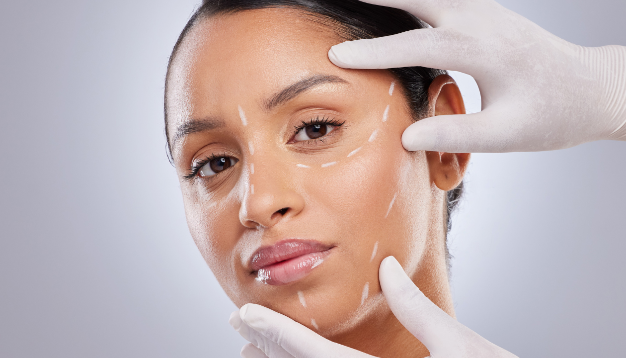 PDO Thread Lift Recovery & Results - Kure Aesthetics in Mount Pleasant, WI